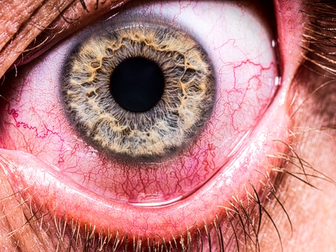 Aldeyra Therapeutics: Reproxalap's CRL Creating A Buying Opportunity ...