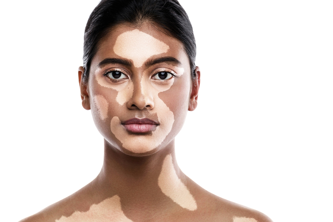 Incyte wins EU nod for vitiligo cream Opzelura (NASDAQ:INCY) | Seeking ...