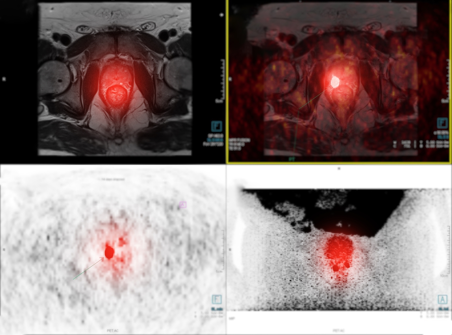 ESSA Pharma: Combination Shows Efficacy In Prostate Cancer (TSXV:EPI:CA ...