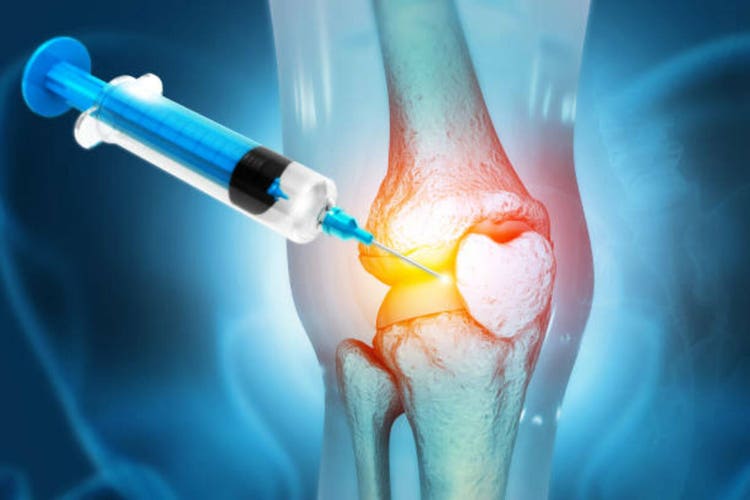 Pacira releases positive two-year data on knee osteoarthritis candidate ...