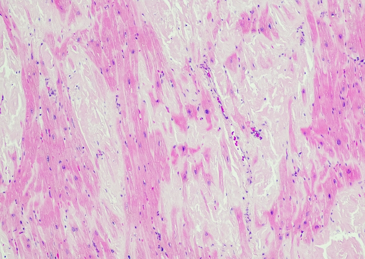 Alnylam wins FDA panel backing additional Onpattro indications ...