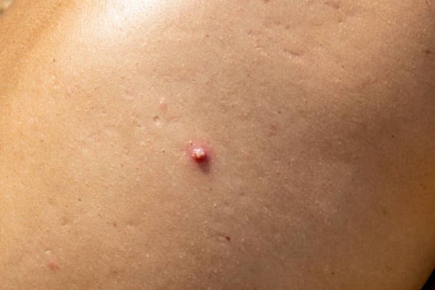 MoonLake eyes FDA filing this fall on one-year results for skin ...