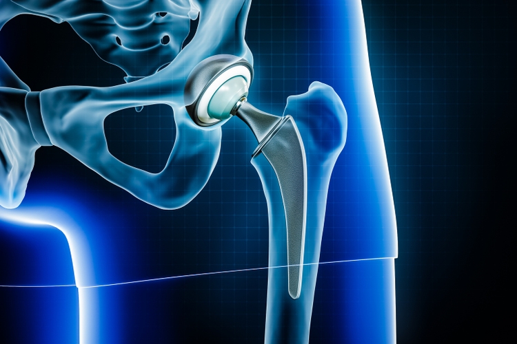 Zimmer Biomet hip replacement system subject of FDA alert (NYSE:ZBH ...