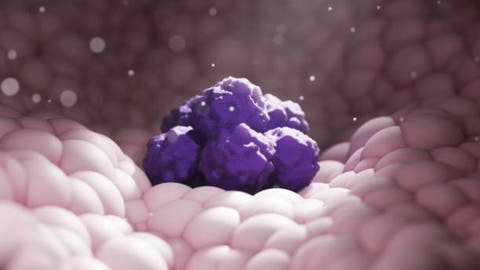 Jazz Pharma lung cancer drug fails in late-stage trial (JAZZ) | Seeking ...