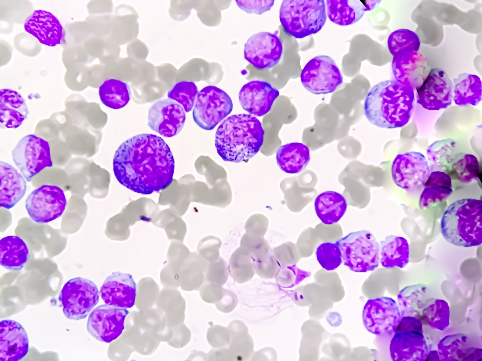 Kura Oncology: Expect Volatility Following Ziftomenib Phase 1b Data ...