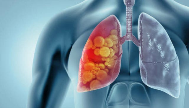 Roche's Genentech gets FDA nod for lung cancer treatment | Seeking Alpha