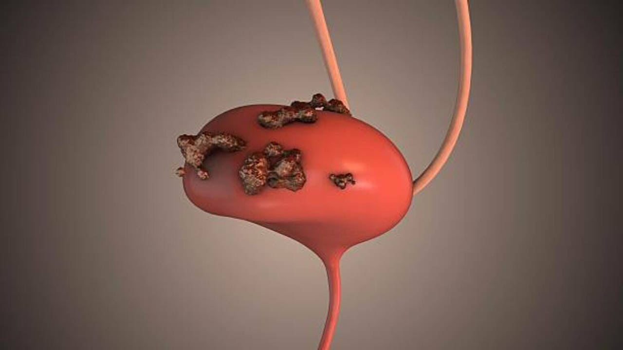 UroGen closes up 43% ahead of FDA decision on bladder cancer candidate ...