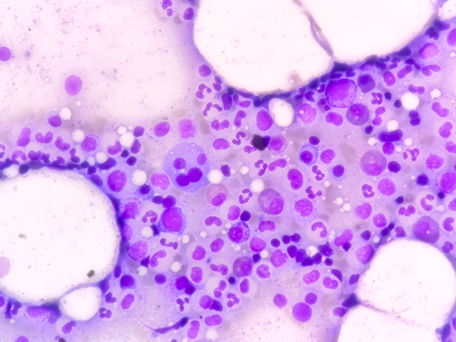 Iovance Biotherapeutics: Progress With Caveats (NASDAQ:IOVA) | Seeking ...