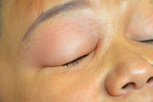 Pharvaris achieves primary goal in late-stage trial of deucrictibant for HAE | Seeking Alpha