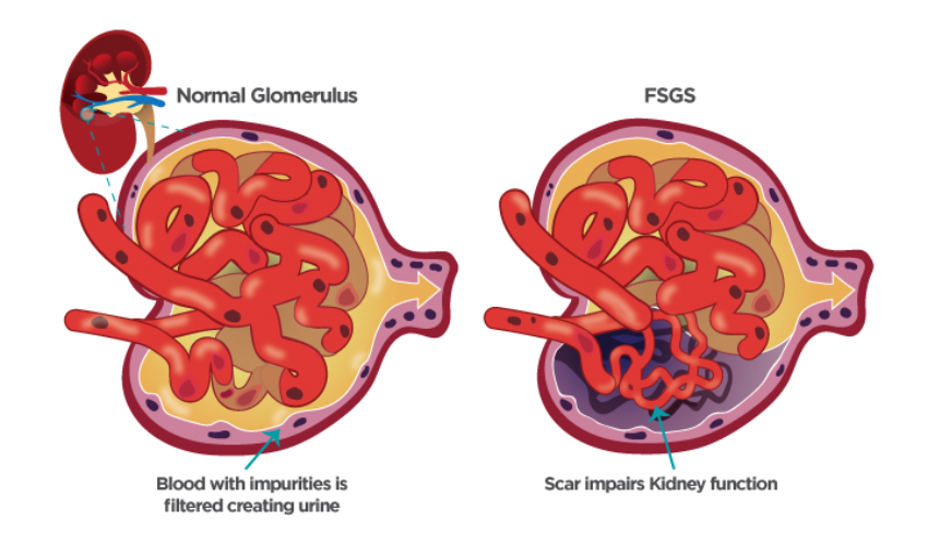 Aurinia And Voclosporin: Making A Difference In Focal Segmental ...