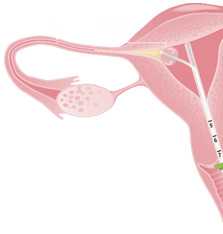 Femasys: Ready To Turn The Corner (NASDAQ:FEMY) | Seeking Alpha