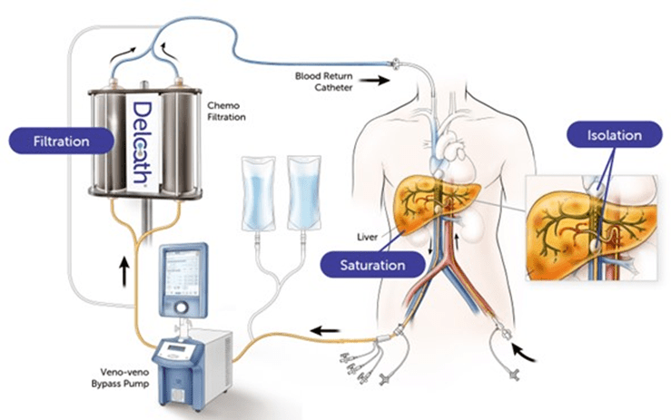 Delcath: Large Upside With Limited Downside Risk (NASDAQ:DCTH ...