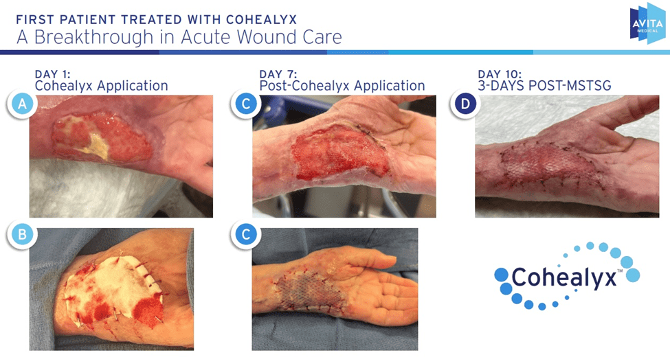 After Sales Rebound In January, AVITA Is Set Up For A Monster Year ...