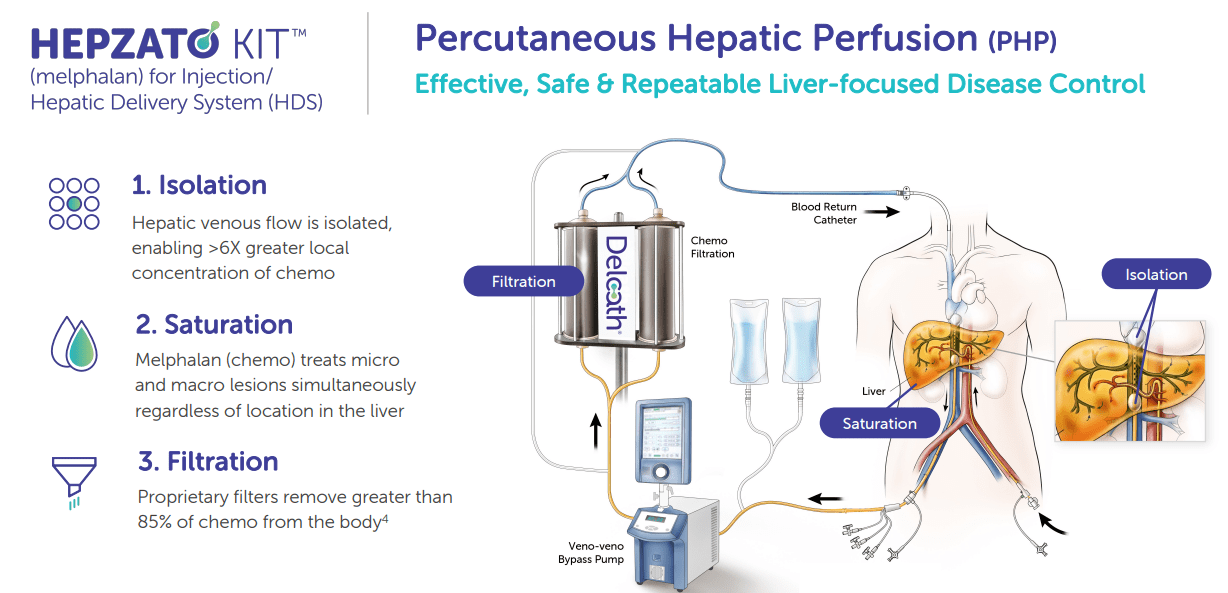 Delcath Systems: Huge Potential But With The Handbrake On For Now ...