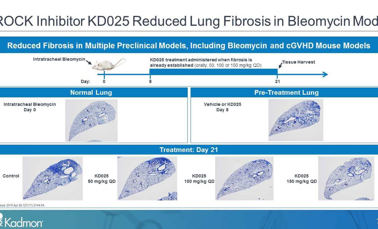 Kadmon (KDMN) Presents On KD025 In IPF: Topline Results - Slideshow ...